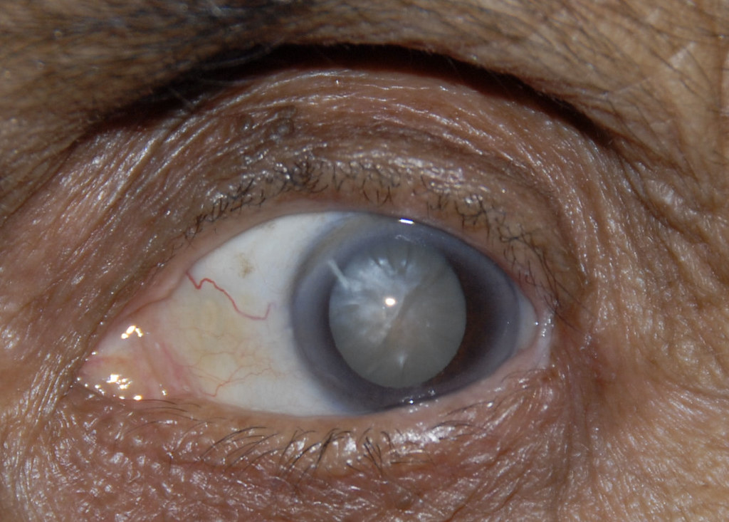 Mature cataract | This white cataract (note that the pupil i… | Flickr