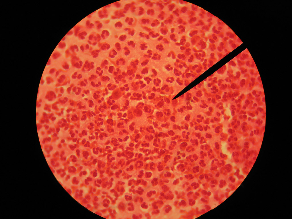 Neisseria Gonorrhoeae Gram Stain Gonorrhea Cells Stock Photos And