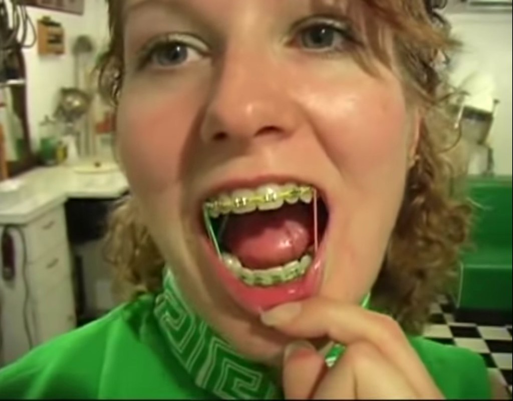 Braces Metalmouth Lover Flickr